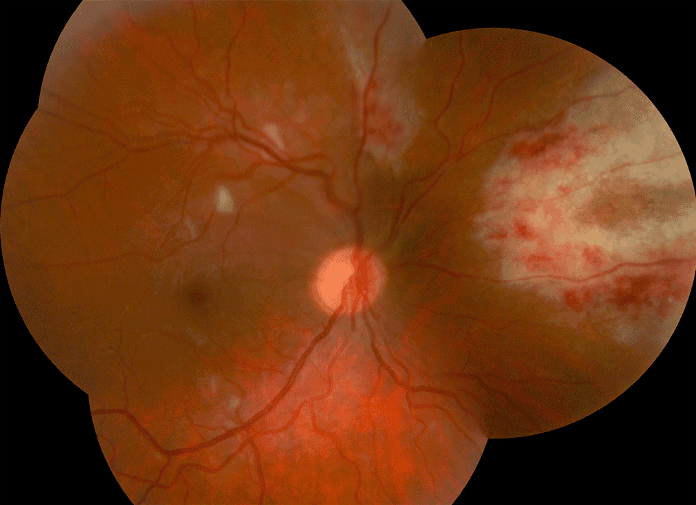 Tratamiento de la retinitis por citomegalovirus - Uveitis Network Chile